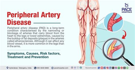 Peripheral Artery Disease Pad Symptoms Causes And Treatment