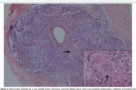 Figure 2 From Anti Tuberculosis Treatment For Idiopathic Granulomatous Mastitis Mimicking Breast