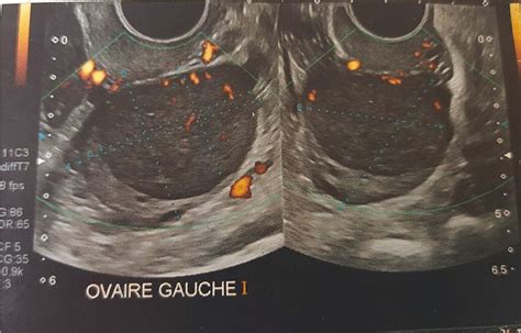 Ultrasound Image Showing An Organic Left Ovarian Mass Measuring 39 Mm