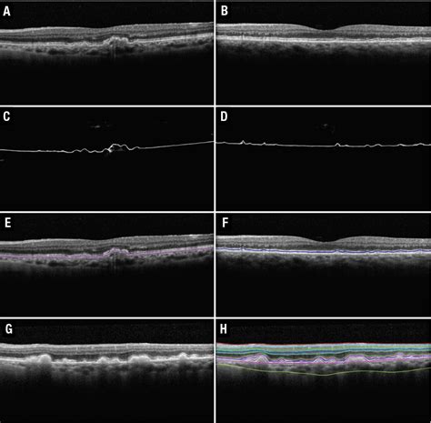 Deep Learning For AMD Screening And Detection