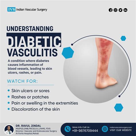 Dr Ravul Jindal On Linkedin Diabeticvasculitis Skinulcers