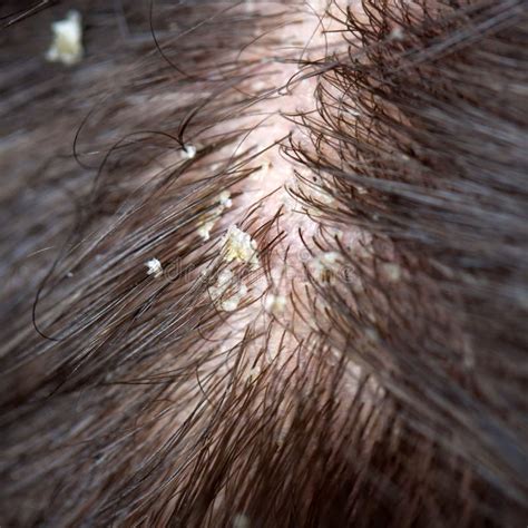 Holes In Scalp