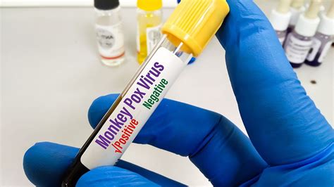 Mpox Cases Remain Low Cdc Still Urges Vax For Those At Risk