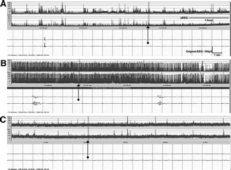 Amplitude Integrated Electroencephalogram Aeeg Patterns A Flat Download Scientific Diagram