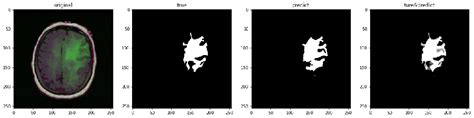 GitHub Convolutional Neural Network For Brain Lesion Segmentation In MRI Images In