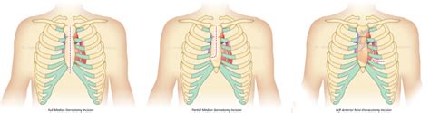 Sternotomy And Thoracotomy Incisions Jessica Parmley