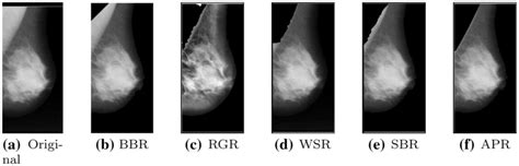 Pectoral Muscle Removal Algorithms In Action Download Scientific Diagram