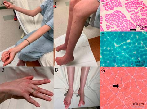 Diffuse Decreased Muscle Bulk With Contractures And Mild Variation In Download Scientific