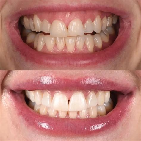 Invisalign Before And After Before After Journey