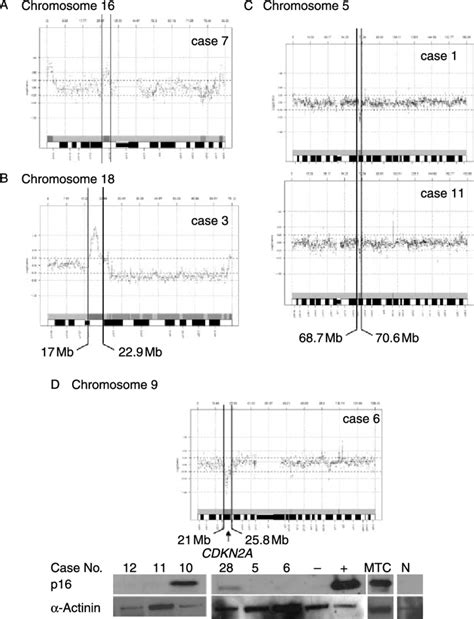 A Array Cgh Profile Exemplifying The Frequent Gain Of Chromosome 16 Download Scientific