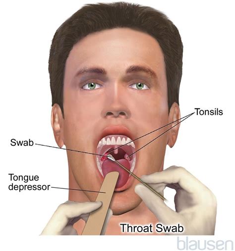 Throat Infection Ear Nose And Throat Disorders Msd Manual