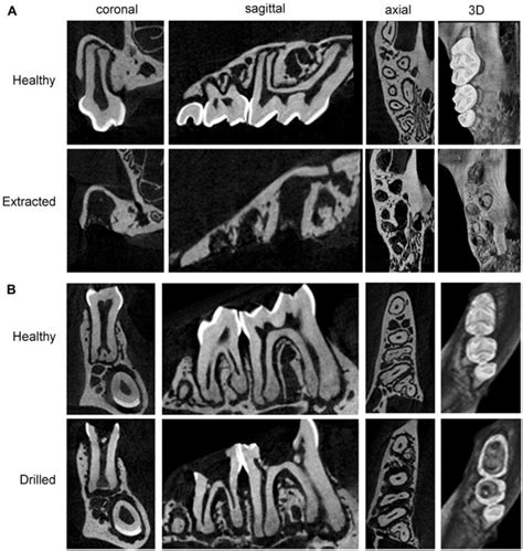 Bisphosphonate Uptake In Areas Of Tooth Extraction Or Periapical Disease Abstract Europe Pmc