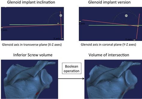 To Measure The Glenoid Implant Inclination And Version A Virtual