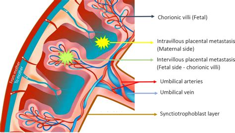 Placenta Metastasis A Intravillous Space Or Fetal Side Placenta