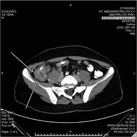 CT Scan Shows Acute Appendicitis With Localized Perforation Marked Download Scientific Diagram