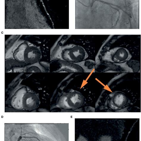 Example Of The Usefulness Of Multi Modality Imaging In Placing A
