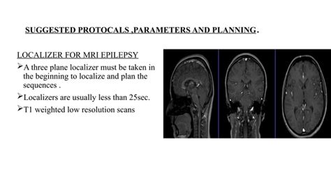 10 Mri Brain Epilepsy Seizure Protocol 2 Pptx