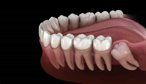 Wisdom Tooth Removal Kigodental