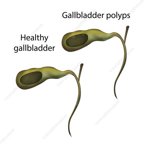 Gallbladder Polyps And Healthy Gallbladder Illustration Stock Image F028 0221 Science