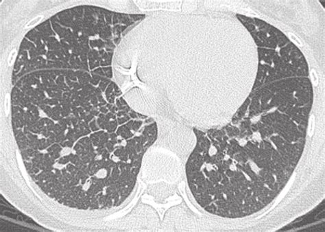 Engraftment Syndrome In A 25 Year Old Woman With A Fever 17 Days After