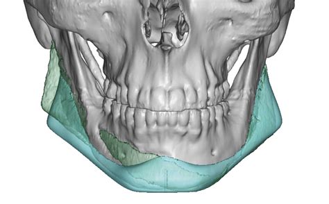 Jawline Implant Design Overlaid On Existing Chin And Jaw Angle Implants