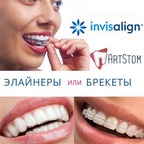 3d Printing Invisalign