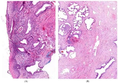 Ectopic Prostate Tissue In The Uterine Cervix Of A Female With Non