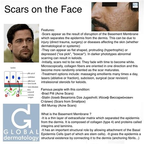 Brad Pitt Acne Scars