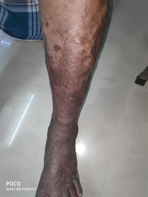 Lipodermatosclerosis Medizzy