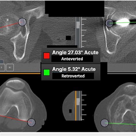Pre Correction Ct Scanogram With Pre Correction Femoral Rotation Download Scientific Diagram