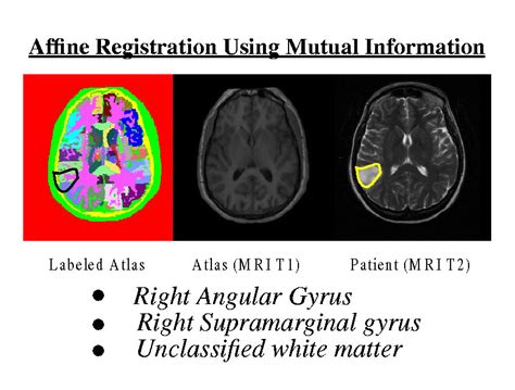 Using Maximization Of Mutual Information Method To Register A 3d