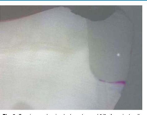 Figure 1 From The Effect Of Flowable Composite Lining Thickness With Various Curing Techniques