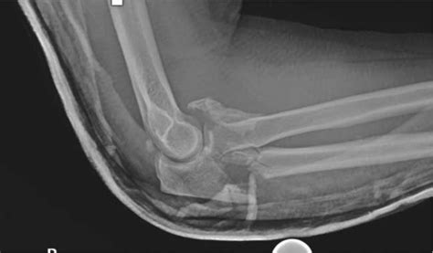 Case 2 Comminuted Trans Olecranon Fracture Dislocation Download Scientific Diagram