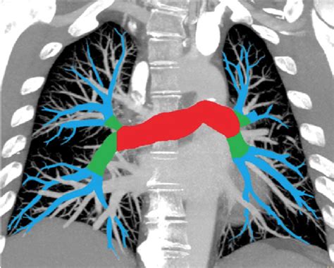 Classification Of Anatomical Location Of Pulmonary Embolism Blue Download Scientific Diagram