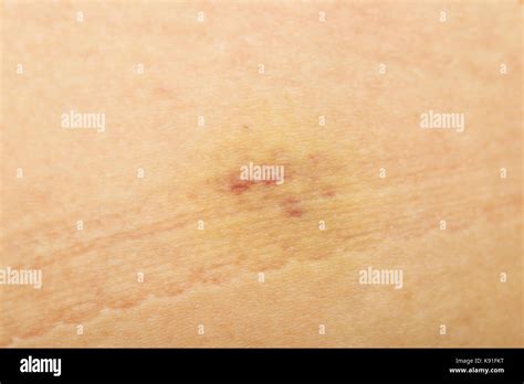 Bruises After Injection Stock Photo Alamy