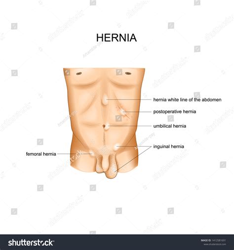 Vector Illustration Hernia Types By Location Stock Vector Royalty Free 1412581691 Shutterstock