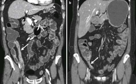2 Ct Enteroclysis Cte Vs Ct Enterography Cte Both Cte A And Download Scientific