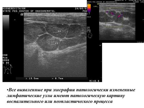 Анатомия и основы ультразвуковой диагностики органов лимфатической системы презентация онлайн