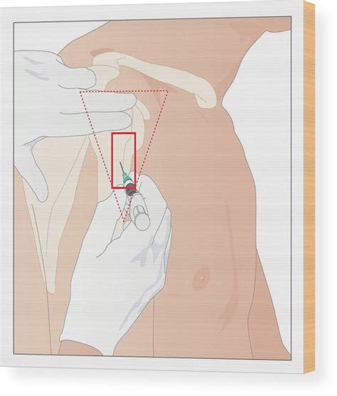 Deltoid Muscle Injection Im Injection Sites Pnii Deltoid
