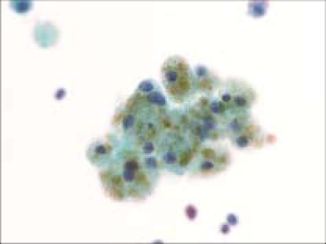 Hemosiderin Laden Macrophages And Hemosiderin Within Follicular Cells
