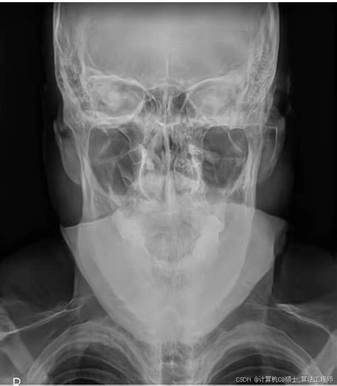 采用深度学习使用卷积神经网络（cnn）选择efficientnet预训练模型进行微调医疗图像数据集，处理训练应用ct，x光射线，核磁共振的