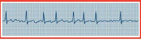 AFib And AFlutter Flashcards Quizlet