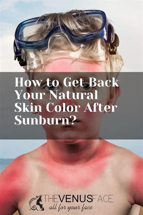 How To Get Back Your Natural Skin Color After Sunburn