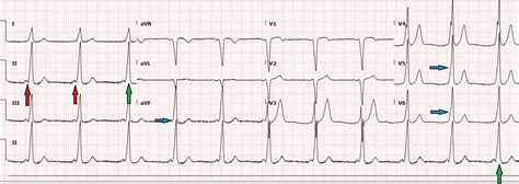 Delta Wave Ecg