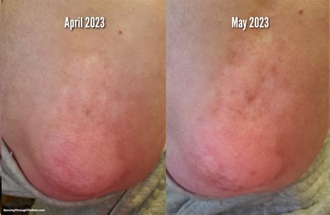 24 Weeks On Opzelura A Vitiligo Treatment Update With Pictures