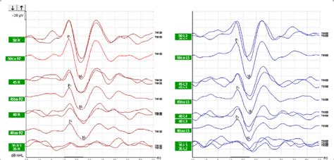 Bone Conducted CVEMPs Responses Were Obtained From The Same Female Download Scientific Diagram