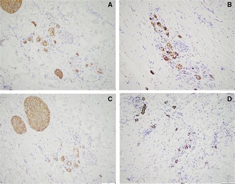 Neoplastic Epithelial Component Of The Tumor Demonstrating Positivity Download Scientific