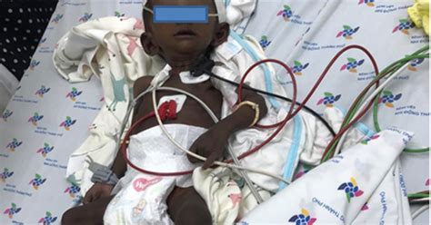 Bé gái bị suy tuyến thượng thận khiến da đen sạm