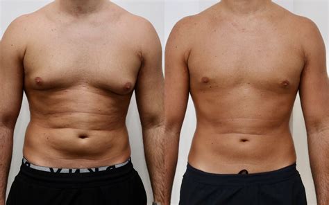 Gynecomastia Surgery Male Breast Reduction Edinburgh