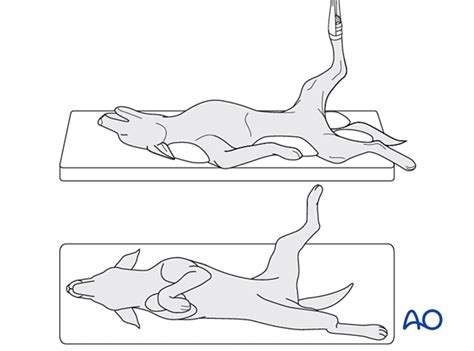 Pin And Tension Band Fixation For Partial Articular Medial Malleolar